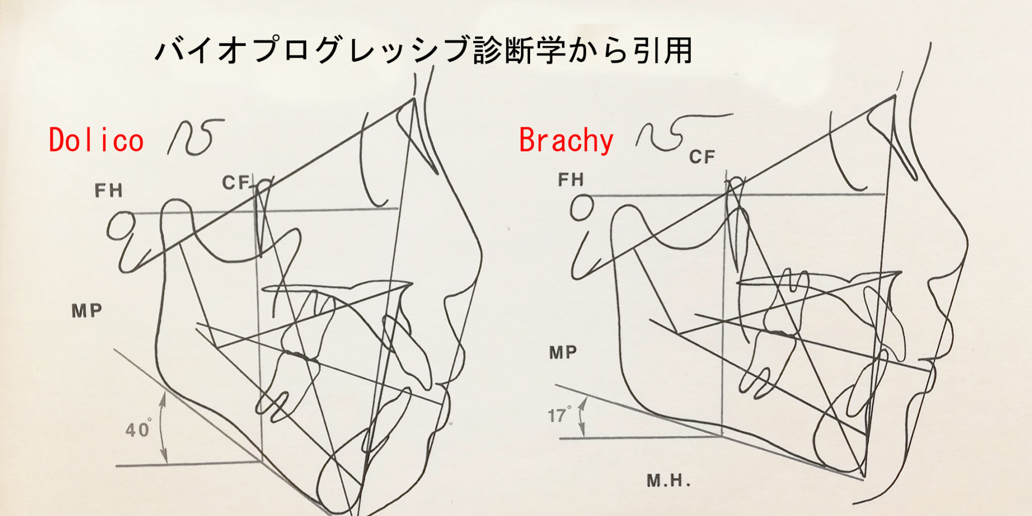 面長・丸顔・えらはり顔と矯正治療